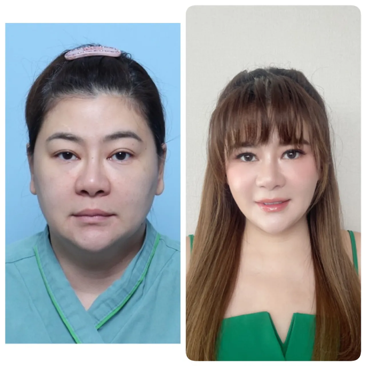 โอ๋ ภัคจีรา โพสต์รีวิวพลีชีพ เทียบภาพชัดๆ ก่อนและหลังศัลยกรรมวัย 48 ปี | SootinClaimon.Com